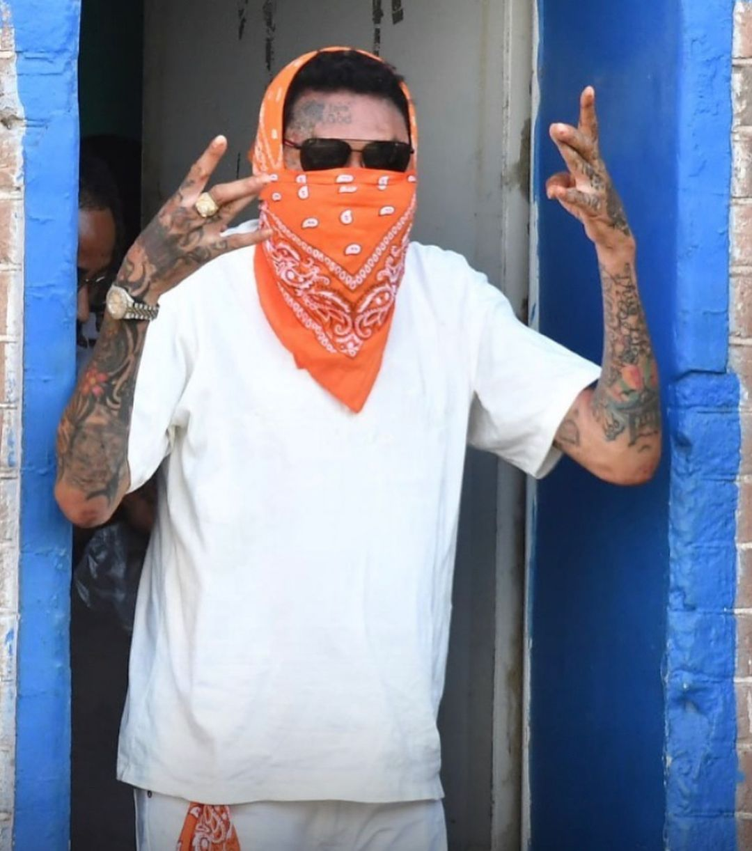 Why is Vybz Kartel's face swollen?